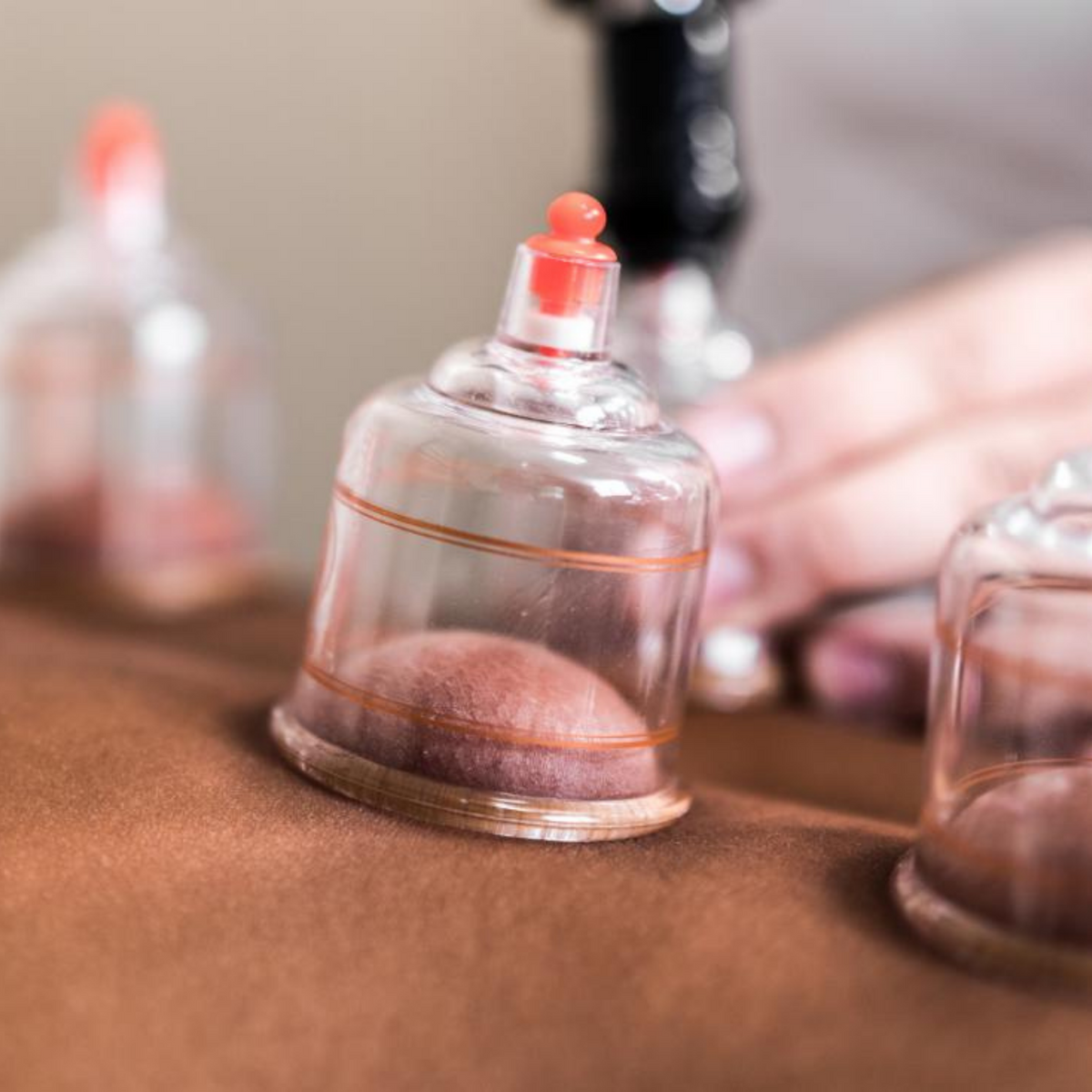Book Your Dry Cupping Therapy in Solihull Today! – Simon Evans ...